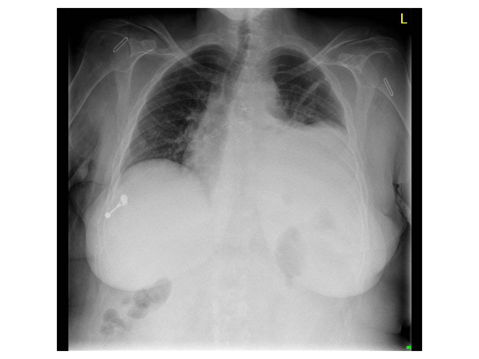 Pleural effussion: a detail for localization – Prodiagnosis / Foro Osler