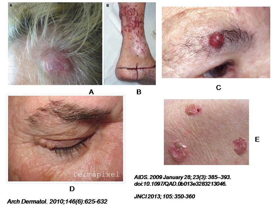 Diagnosis of cutaneous tumors in HIV infection – Prodiagnosis / Foro Osler