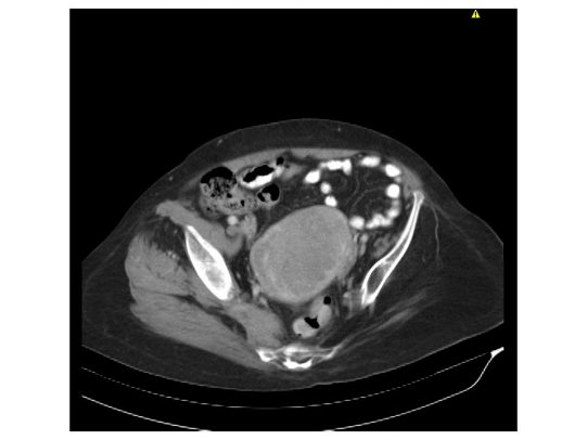 Confirmation bias: an expert missing a spinal cord compression ...