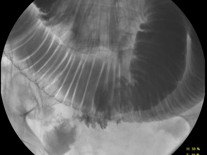 Enteroclisis: the value of an expert radiologist – Prodiagnosis / Foro ...