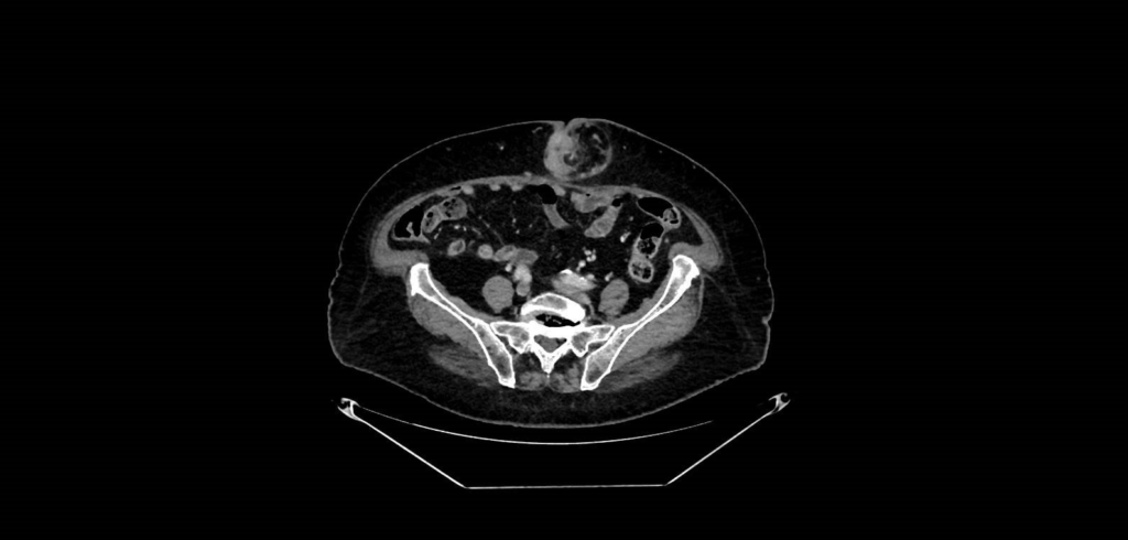hernia (1) – Prodiagnosis / Foro Osler