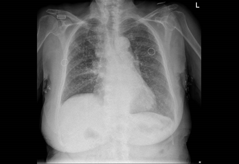 The importance of genetic diagnosis in cancer: adenocarcinoma subtypes ...